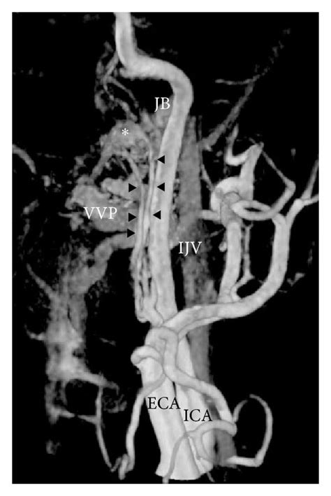Three Dimensional Digital Subtraction Angiography Revealed