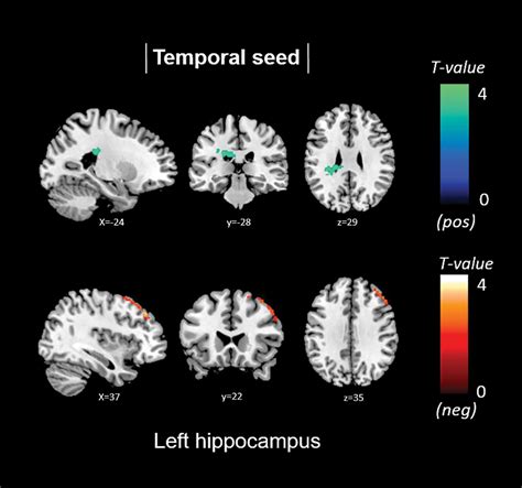 Frontiers Altered Interplay Among Large Scale Brain Functional