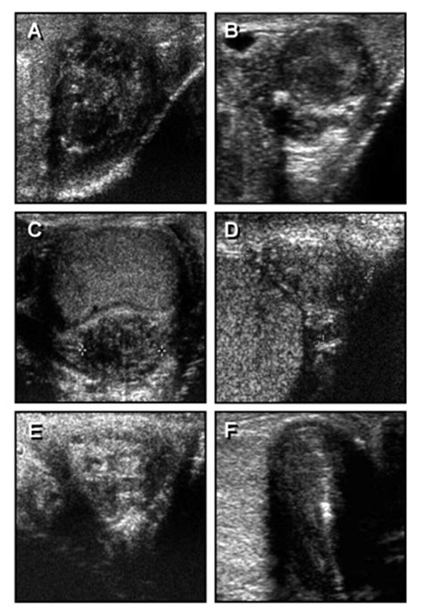 Epididymis Lump Ultrasound