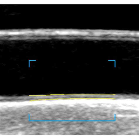 Measurement Of Carotid Intima Media Thickness This Figure Shows The