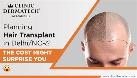 Top 138 Long Hair Transplant In Delhi Polarrunningexpeditions