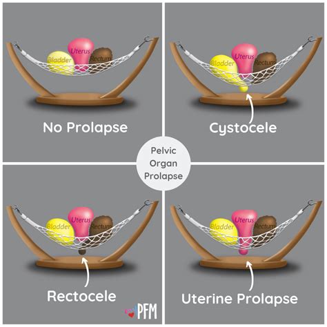 Pelvic Organ Prolapse And Pregnancy My Top Three Tips At Navigating