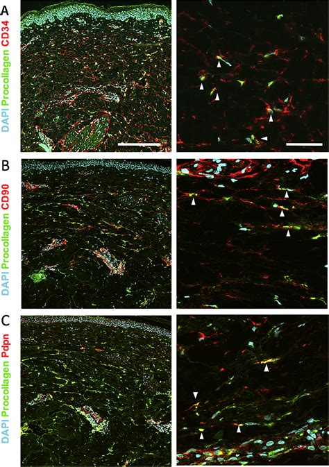 Altered Dermal Fibroblasts In Systemic Sclerosis Display Podoplanin And