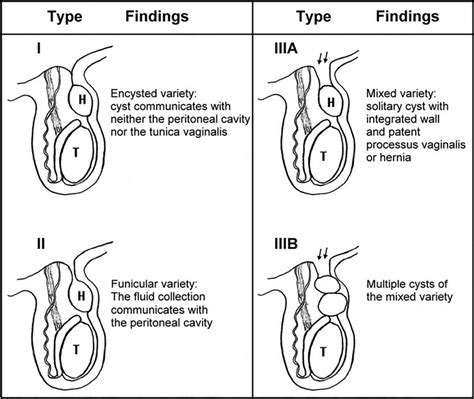 Schematic Diagram Showing Classification Of Hydrocele According To The