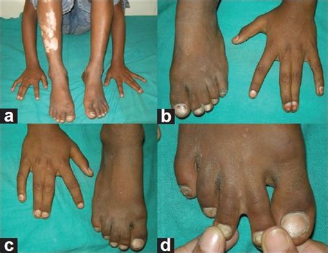 Waardenburg Syndrome A Report Of Three Cases Indian Journal Of