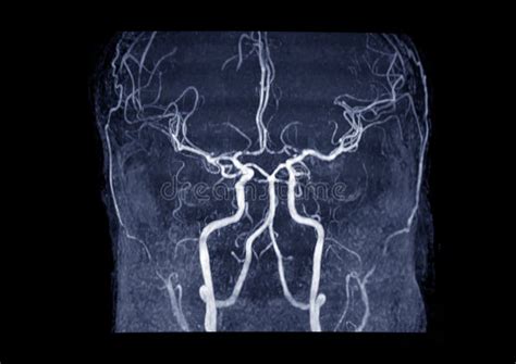 Angiografía De Resonancia Magnética O Cerebral De La Arteria Cerebral