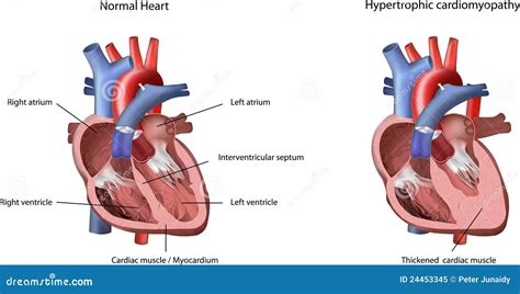 Heart Problem Hypertrophic Cardiomyopathy Stock Vector Illustration