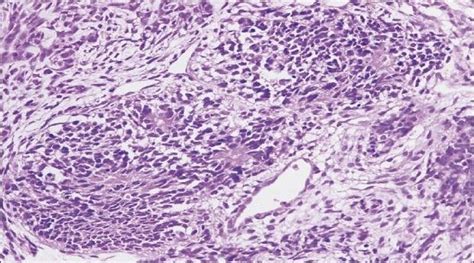 Histopathology Showing Primitive Neuroepithelial Cells Forming Rosettes