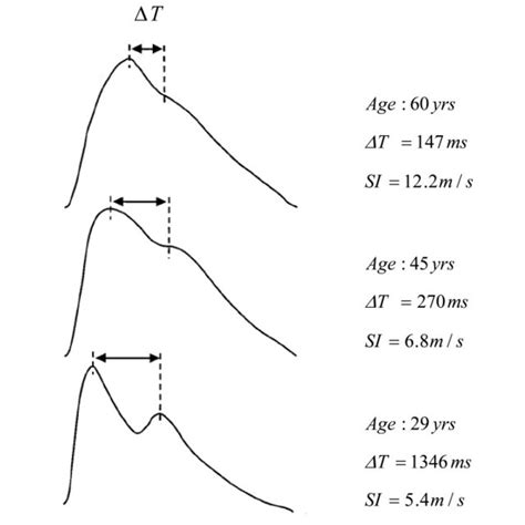 A Typical Waveform Of The Ppg And Its Characteristic Download