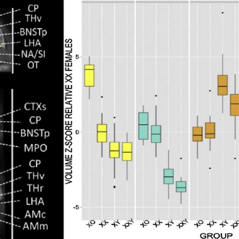 Pdf X Chromosome Regulation And Sex Differences In Brain Anatomy