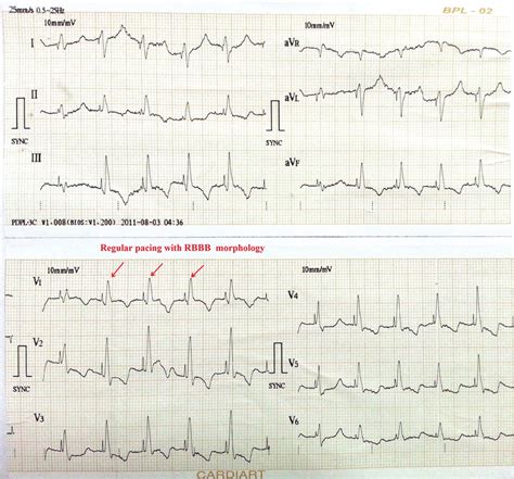Pacemaker Ekg Strip