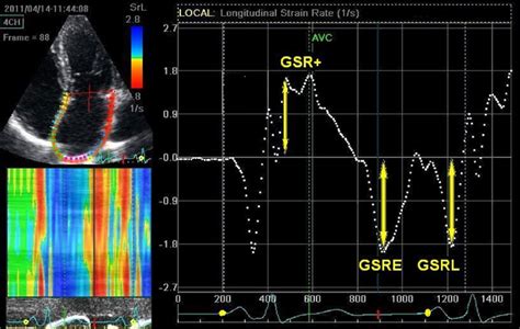 Measurement Of Left Atrial Longitudinal Strain Rate Parameters By