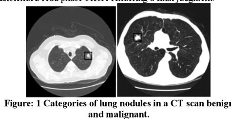 Figure 1 From A Cnn Based Machine Learning Scheme To Detect Lung Cancer