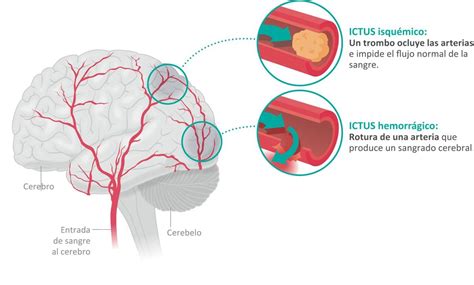 Ictus Daño Cerebral Adquirido Señales De Alerta