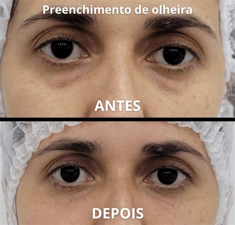 Preenchimento Com Ácido Hialurônico Dra Érica Barros