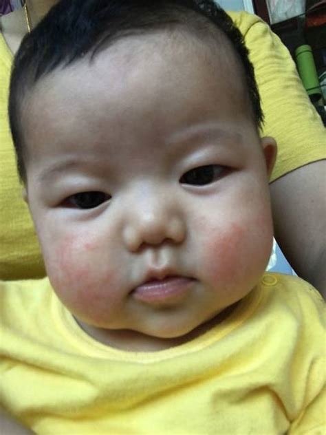 两个月宝宝脸上湿疹怎么办 婴儿脸部湿疹初期图片 随意云