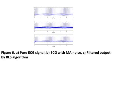 Denoising Ecg Signal Using Adaptive Filter Algorithm R Pradeep Kumar