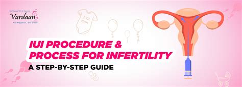 The Intrauterine Insemination Iui Process Step By Step 43 Off
