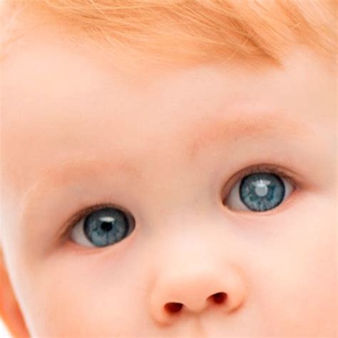 Congenital Cataracts Treatment London Private Eye Clinic