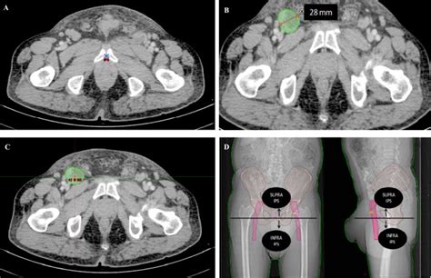 Recommendations And Clinical Validation Of Inguinal Clinical Target