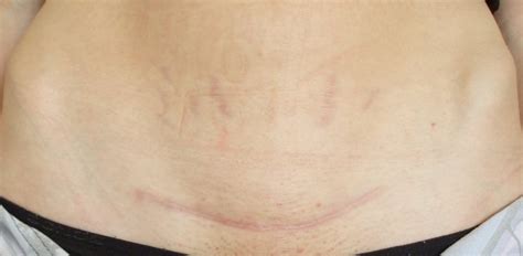 Caesarean Scar Pictures