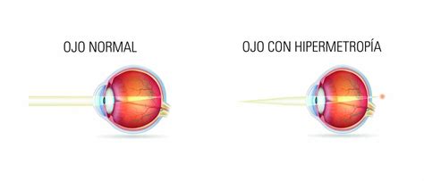 Hipermetropía En Niños ¡ojo A Las Señales De Alarma Oftalmedic Salvá