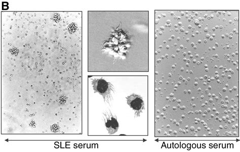 Induction Of Dendritic Cell Differentiation By Ifn α In Systemic Lupus