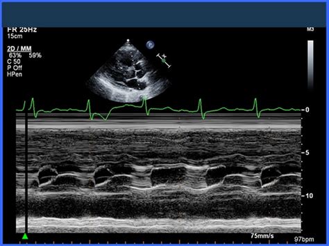 echo case possibly an all time record case of…