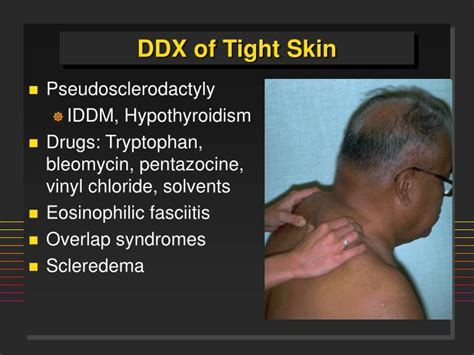 Ppt Scleroderma And Inflammatory Myositis Powerpoint Presentation