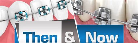 Orthodontic Treatment Braces Then And Now Dental Health Clinic