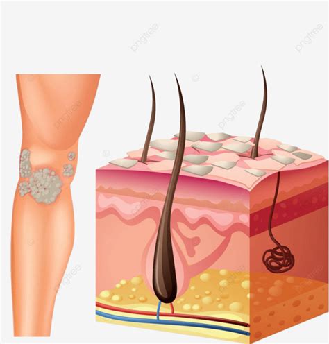 Diagram Showing Psoriasis On Human Skin Picture Graphic Isolated Vector
