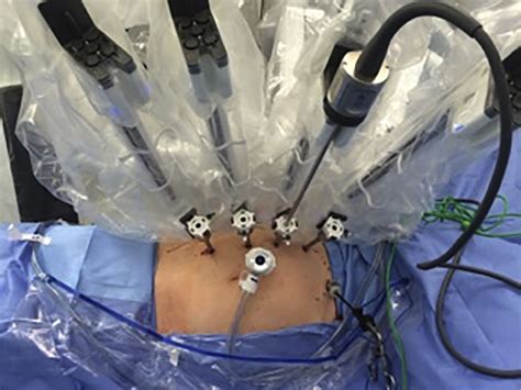 References In Evolution Of Robot Assisted Partial Nephrectomy
