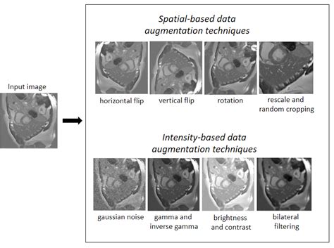 Both Spatial And Intensity Based Data Augmentation Techniques Are