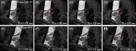 Sequential Series Of Time‐spatial Labeling Inversion Pulse Time‐slip