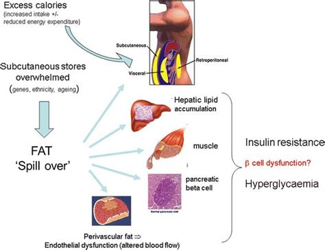 type 2 diabetes as a disease of ectopic fat bmc medicine full text