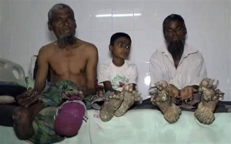 3 Cases Of Tree Man Disease Reported In Bangladesh India Today