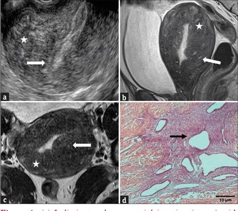 Figure 1 From Diagnostic Role Of Transvaginal Sonography And Magnetic