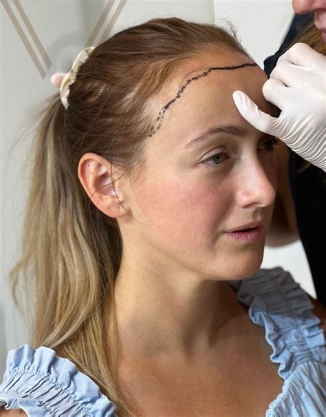 Haartransplantation Bei Frauen In Der Türkei Preise 2024