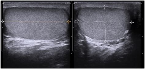 Scrotal Ultrasound Abdominal Key