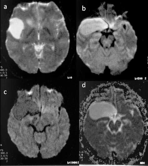 Diffusion Weighted B 0 A B 500 B B 1000 C And Adc Map D