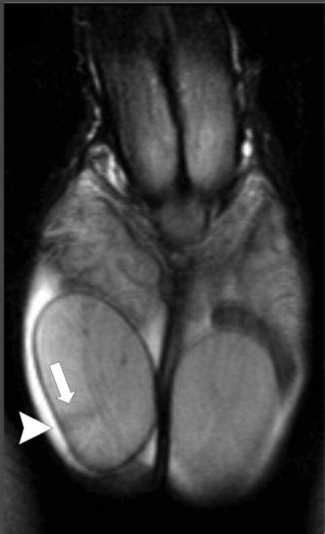 Radiologic Findings Of Segmental Testicular Infarction Ajr
