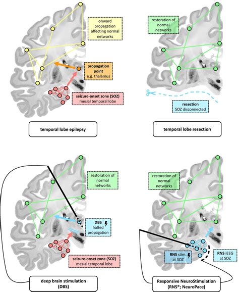 Figure 1 From Towards Network Guided Neuromodulation For Epilepsy