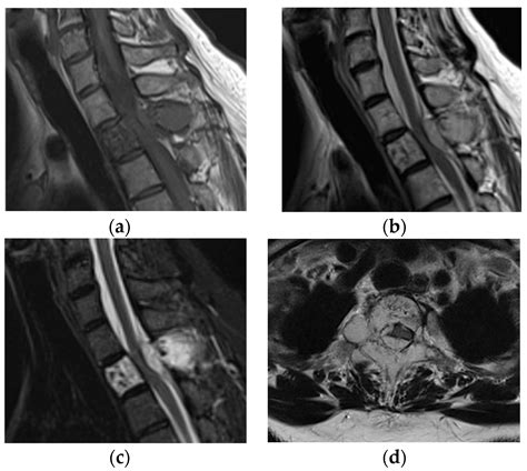 Jcm Free Full Text Ethanol Sclerosis Therapy For Aggressive