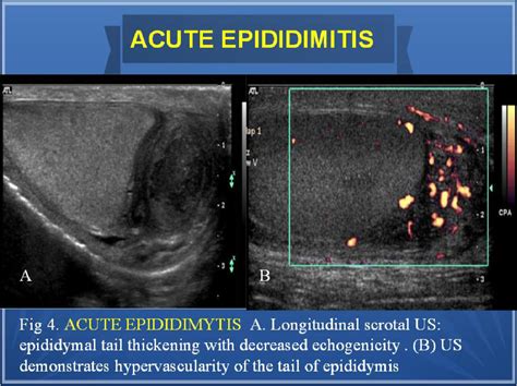 Figure 4 From Sonographic Findings Of Epididymal Masses Semantic Scholar