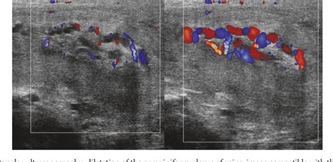 Figure 2 From Two Case Reports Of Varicocele Rupture During Sexual
