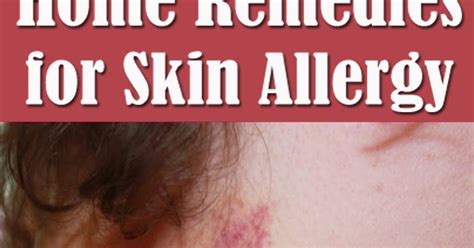 Home Remedies For Skin Allergy