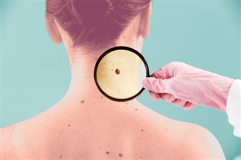 Grains De Beauté Cancéreux Symptômes Et Causes Du Mélanome