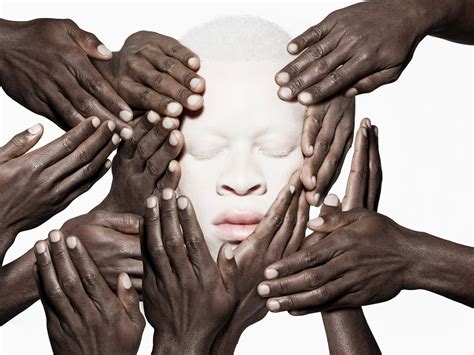 Striking Photos Of African Albinism Moss And Fog