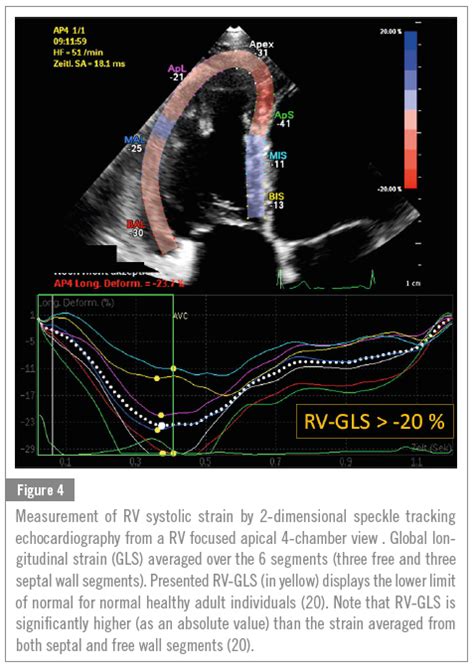 Echocardiographic Criteria For Athlete´s Heart With Cut Off Parameters