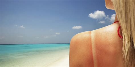 What Actually Happens When You Get A Sunburn Huffpost